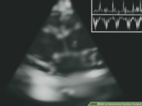 Ways To Determine Cardiac Output WikiHow Health