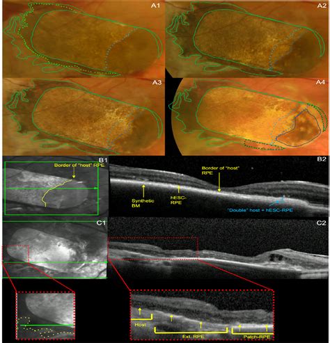 Figure 1 From The Fate Of Rpe Cells Following Hesc Rpe Patch Transplantation In Haemorrhagic Wet