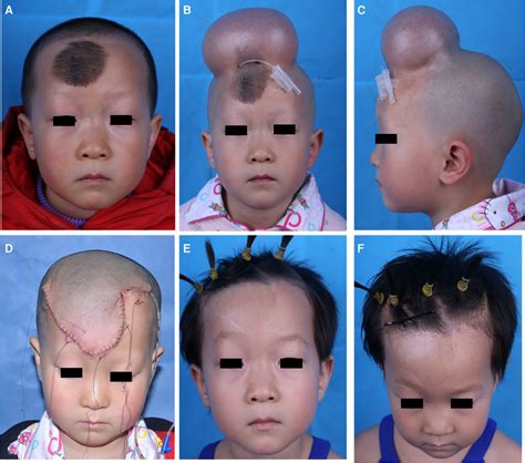 Case 1 A A 4 Year Old Girl With Congenital Nevus 5 × 4 Cm² On