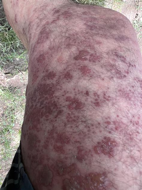 Is This Shingles Rshingles