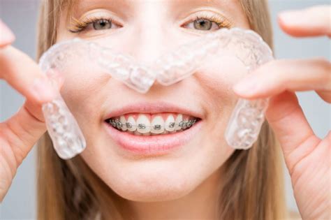 The Difference Between Braces And Clear Aligners Perfect Smile Adelaide