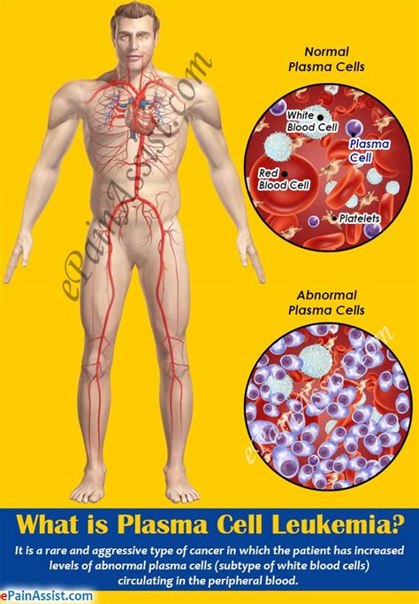 Plasma Cell Leukemiacausessymptomstreatmentprognosisrisk Factors