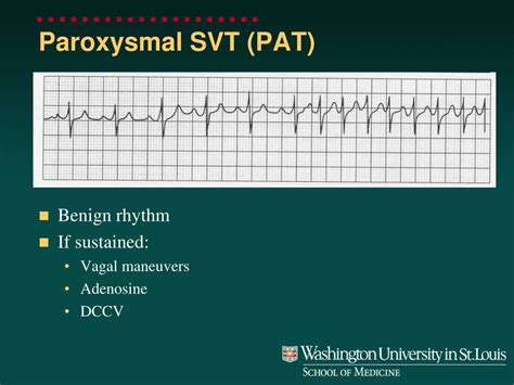 Paroxysmal Atrial Tachycardia Pat