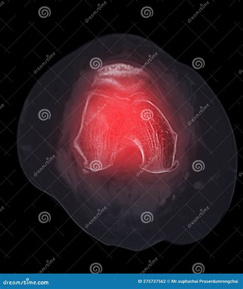 Ct Scan Of Knee Joint Showing Fracture Of Distal Femur Bone Stock