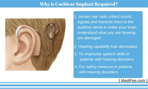 What Is Cochlear Implant Surgery Procedures And Risks Factor