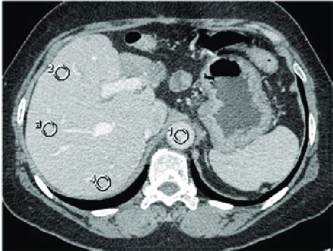 In Case Of Post Left Hepatectomy The 3 Hepatic Rois Were Placed In Download Scientific Diagram