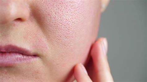 Causes Of Large Pores KenyanVibe