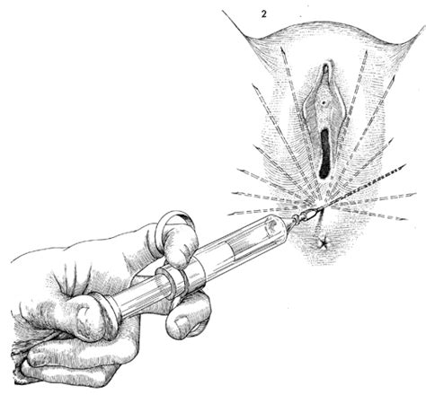 Cortisone Injection Of The Vulva