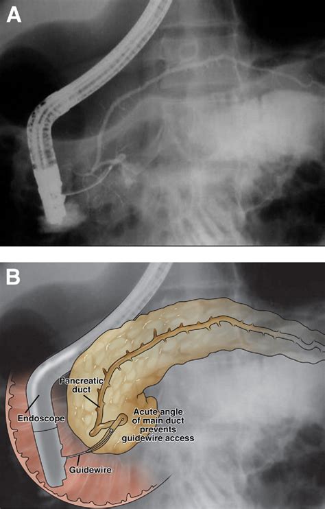 Pancreatogram Demonstrating An Acutely Angulated Main Pancreatic Duct