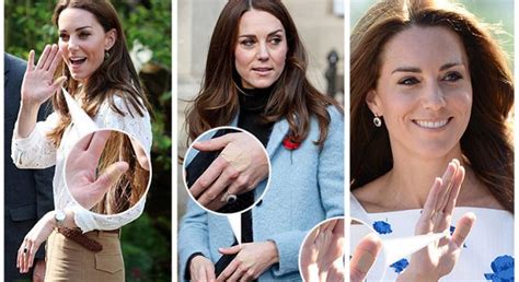 სინამდვილეში რა სჭირს ქეით მიდლტონს ხელებზე და რატომ აკვრია ყოველთვის სანტავიკი