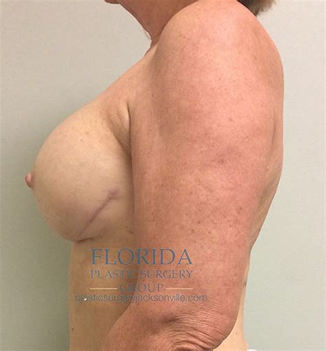 Patient 154948969 Tissue Expander Reconstruction Before And After