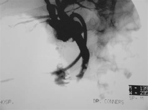 The T Tube Cholangiogram Demonstrates The Presence Of At Least 1 Download Scientific Diagram