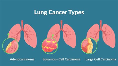 Bronchogenic Carcinoma Types Stages Symptoms And Diagnosis Science Online