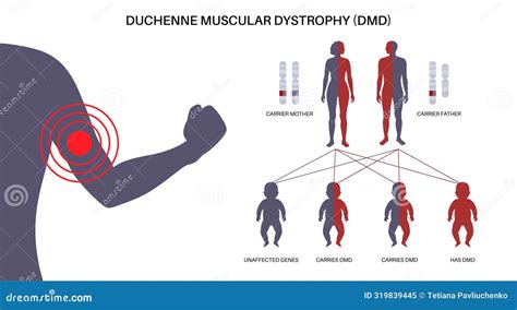 Duchenne Muscular Dystrophy Cartoon Vector 319839445