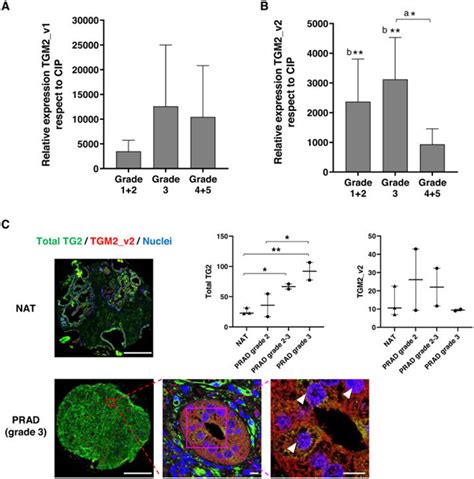 Nature子刊：揭示突变的tg2酶促进前列腺癌进展和扩散机制生物科技健康一线资讯