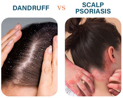 Psoriasis Scalp