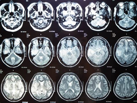 Film X Ray Brain Tumor My Mather Bangkokthailand Stock Illustration