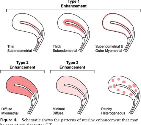 What Is A Tilted Cervix Nhs At Carol Connell Blog