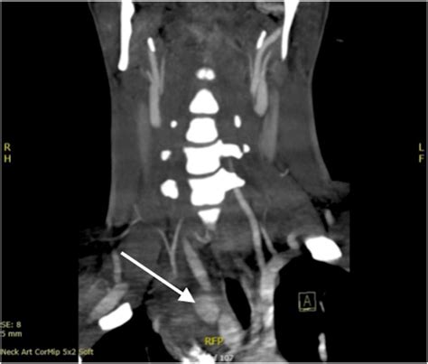 Missed Medial Clavicular Physeal Fracture Posterior Dislocation
