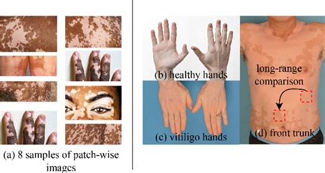 Figure 2 From Bridging The Gap Between Vitiligo Segmentation And Clinical Scores Semantic Scholar