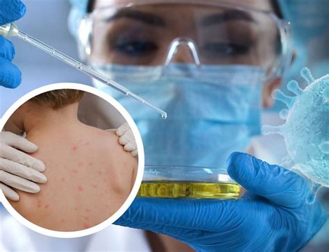 Энэтхэгт сармагчны цэцэг өвчний анхны тохиолдол бүртгэгдлээ Delhii Mn