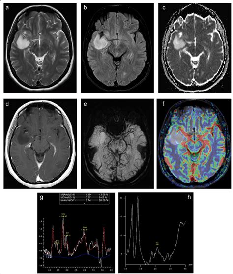 Diffuse Astrocytoma Idh Mutant Grade 2 Tiktoktoktok