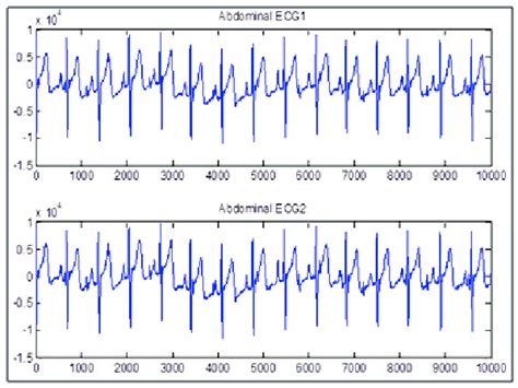 Abdominal Signals After Mixing Mecg And Fecg Download Scientific Diagram