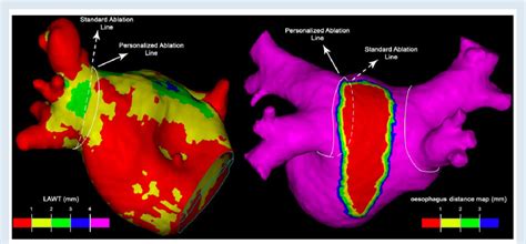 Personalized Ablation Lines In Order To Avoid Antral Thickest Regions Download Scientific