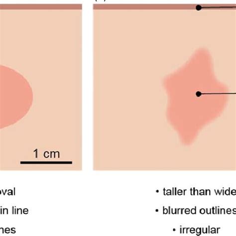 Color Online Comparison Between Benign A And Malignant B Tumors Download Scientific Diagram