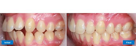 Class Ii Div 1 Central Incisor Protrusion And Anterior Spaces