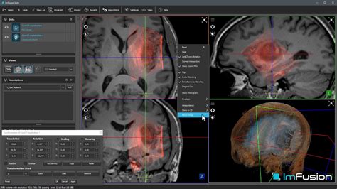 Multi Modal Medical Image Registration Using Imfusion Suite Youtube
