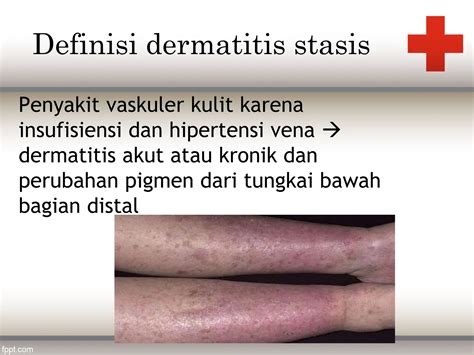 Dermatitis Statis Dermatitis Statis Dejj Pptx