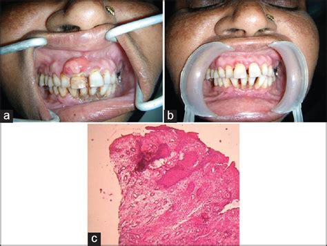 Influence Of Female Sex Hormones On Periodontium A Case Series Pmc