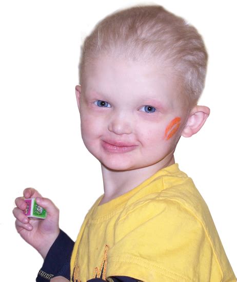 Cedsa Canadian Ectodermal Dysplasia Syndromes Association