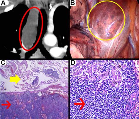 Mediastinal Venous Lymphatic Malformations Thoracoscopic Resection Archivos De Bronconeumología