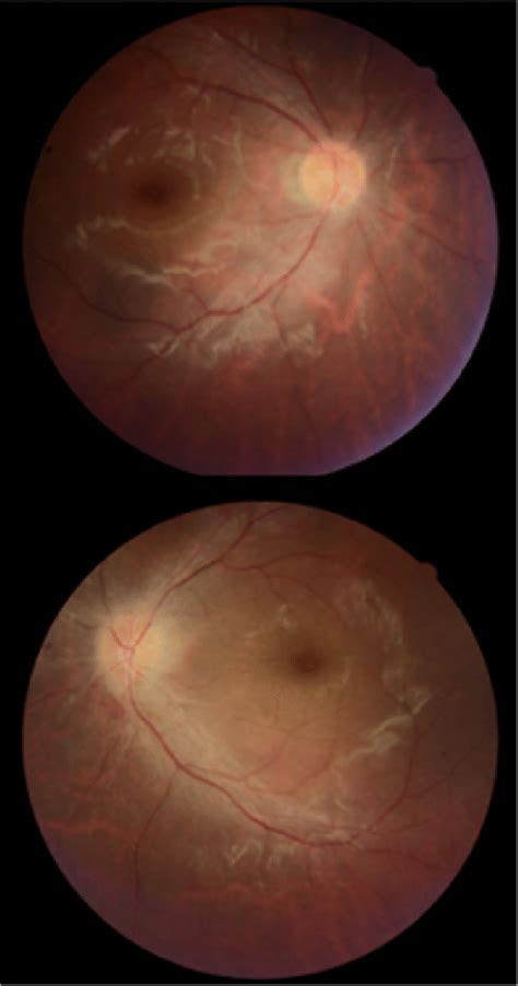 Optic Disc Pallor At Emma Pitt Blog