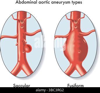 Abdominal Aortic Aneurysm Vector Illustration Stock Vector Image And Art