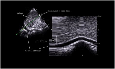 Frontiers Ultrasound Analysis Of Hemidiaphragm Function In Case Of