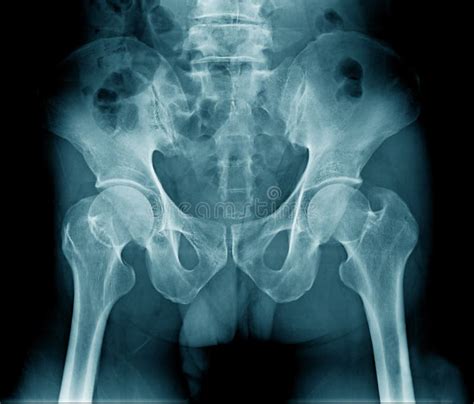 X Ray Pelvic Bone Stock Image Image Of Clinic Anatomy 123029803