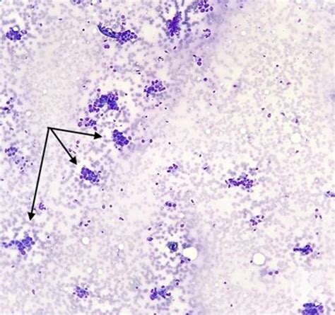 Diffuse Bone Marrow Metastasis Of Breast Cancer 1