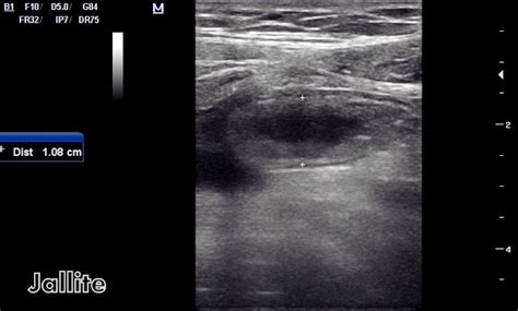 Apendicitis Perforada