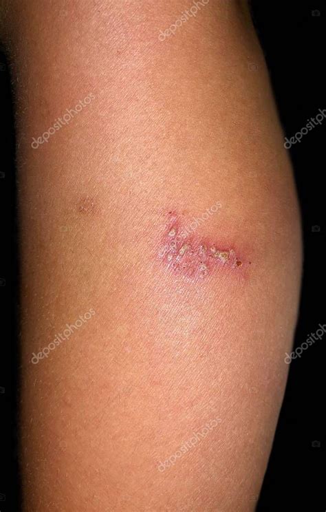 Las Pústulas O La Infección Estafilocócica En La Pierna Del Niño Asiático Lesiones Dolorosas En