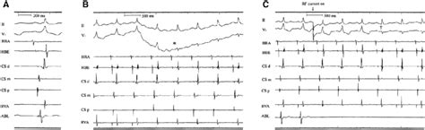 A Electrogram During Sinus Rhythm At The Site Of Successful Ablation