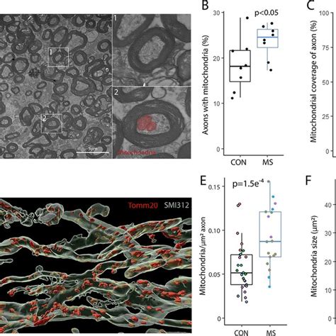 Less Compact Myelin Wrapping In Multiple Sclerosis Ms Download Scientific Diagram