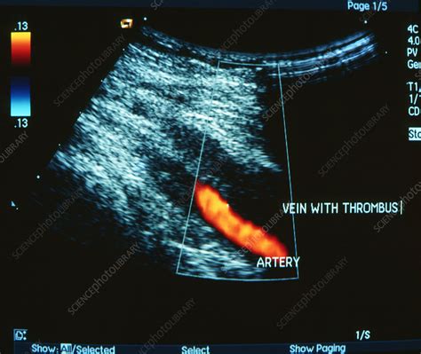 Vascular Ultrasound Dvt