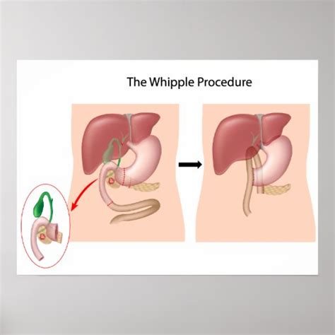 The Whipple Procedure Poster Zazzle