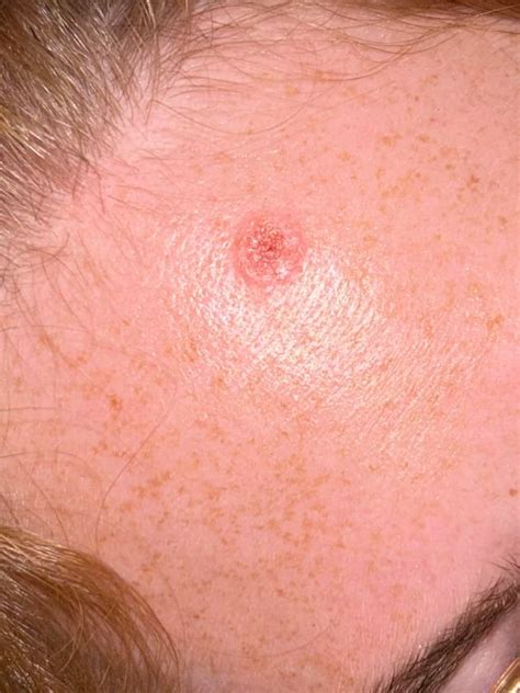 Hi Everyone This Is On My Forehead And Im Not Sure What It Is Im