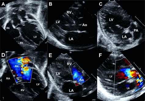 Echocardiogram Of First Patient Movie Subxiphoid Coronal View A Download Scientific