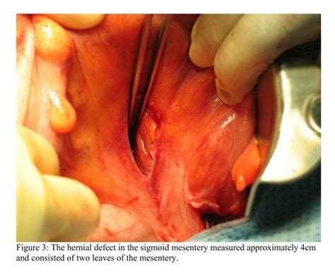 The Hernial Defect Measured Approximately 4 Cm And Consisted Of Two Download Scientific Diagram