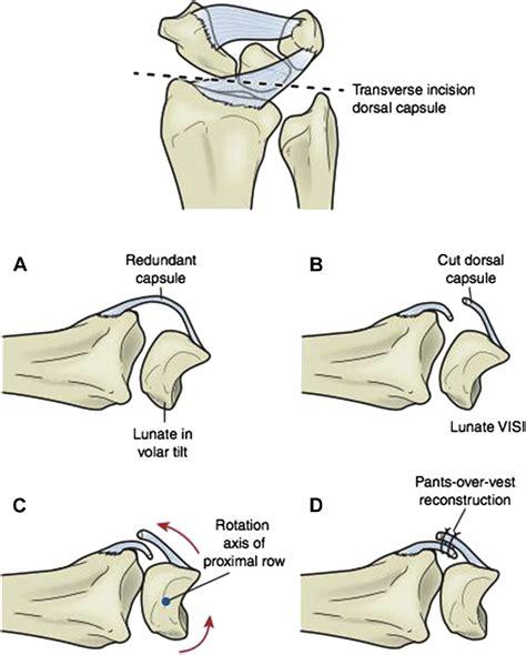Figure 2 From Midcarpal Instability A Comprehensive Review And Update
